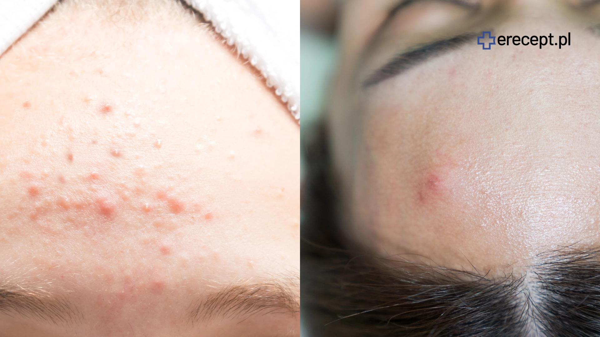 Leki na trądzik na receptę i bez recepty. Poradnik 2025
